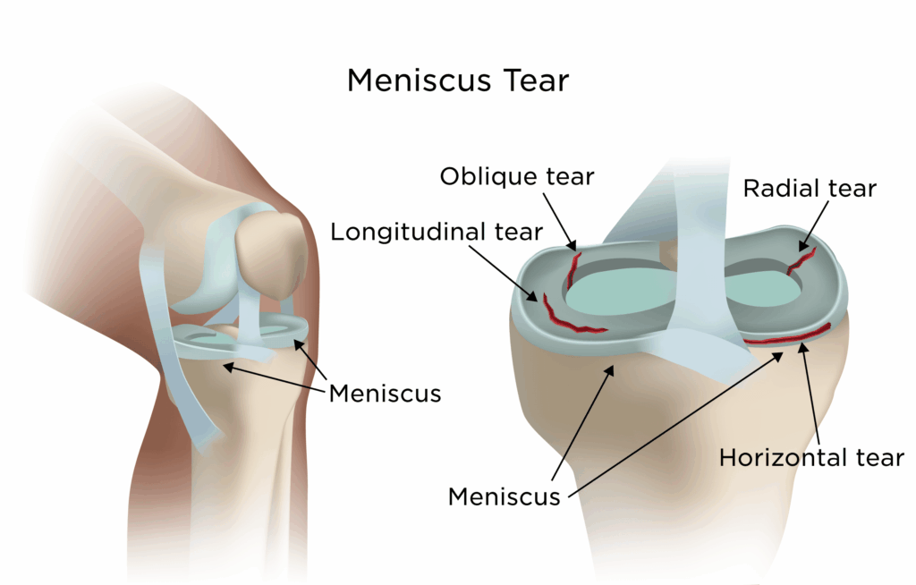 Meniscal Tear Treatment in Chester – Rebound Physio
